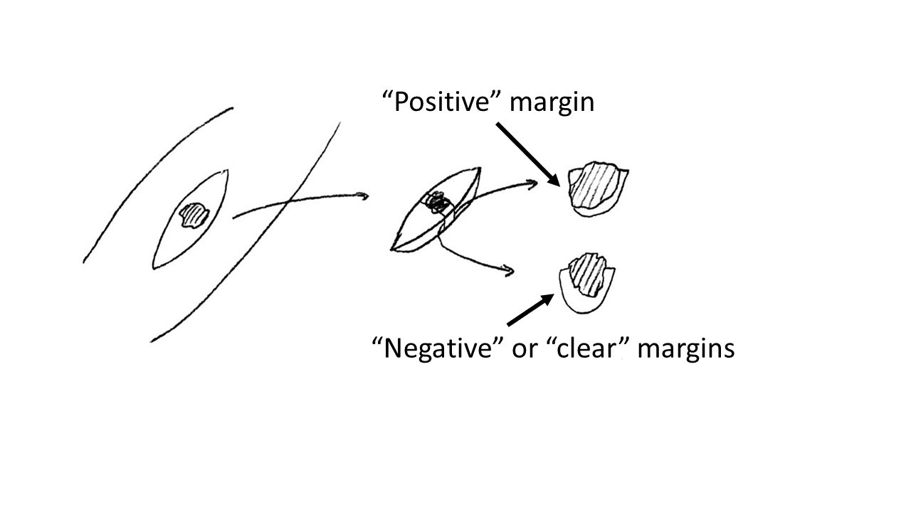 You have a skin cancer for which your doctor recommends Mohs surgery ...