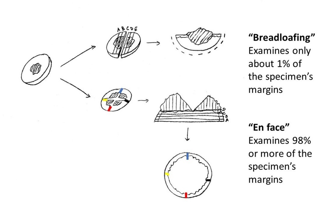 You have a skin cancer for which your doctor recommends Mohs surgery ...
