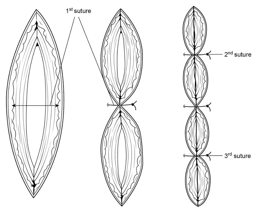 Elliptical wound tension and HEMIGARD™